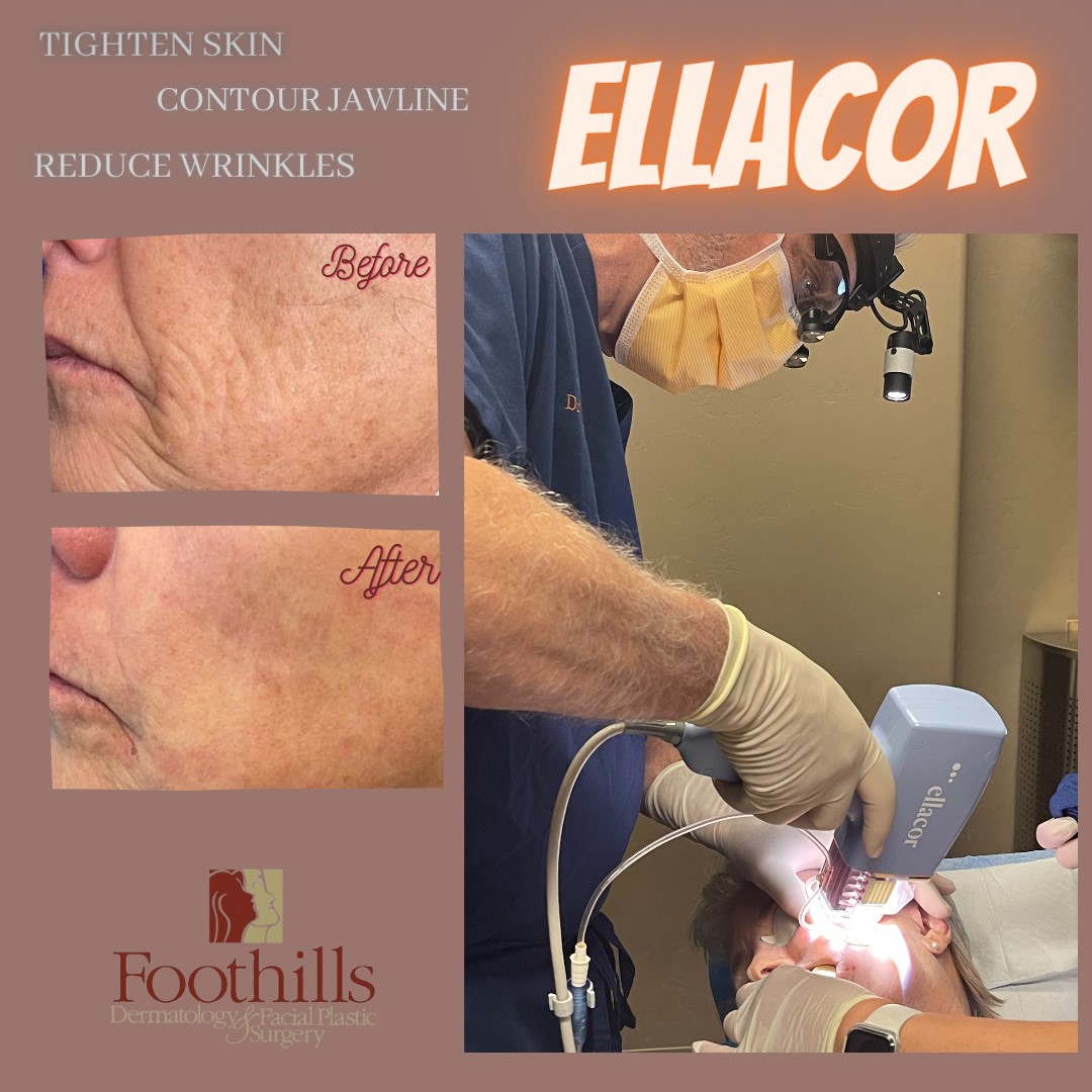 Introducing A First-of-its Kind Procedure | Foothills Facial Plastic ...